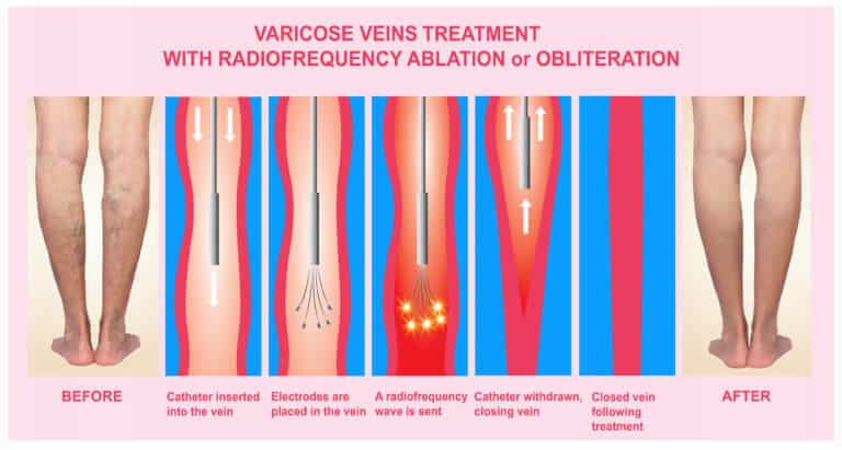 Everything to know about varicose veins in pregnancy | Specialist Vein ...